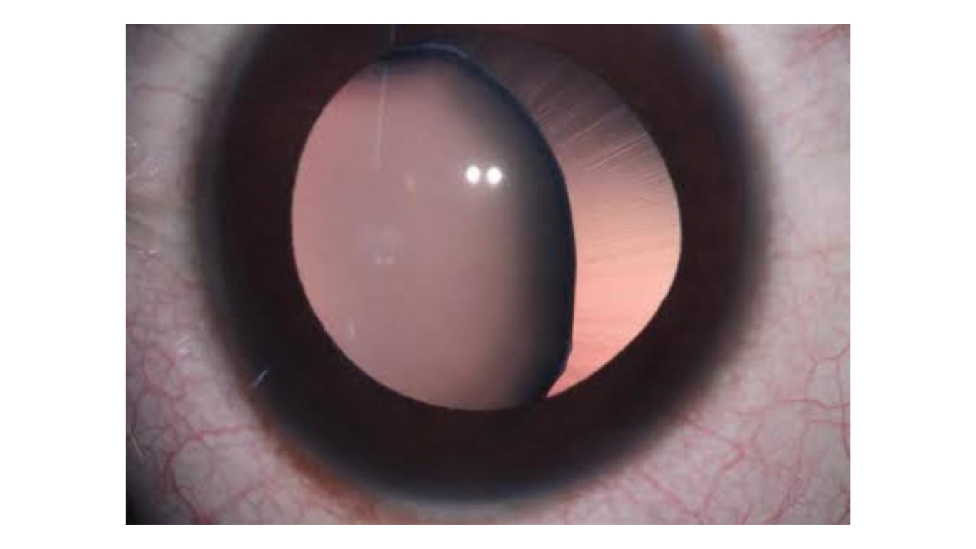 Traumatic Glaucoma: Causes, Symptoms, and Treatment Options