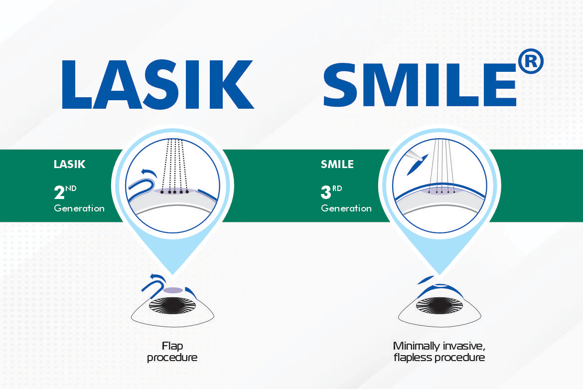 Smile eye surgery cost: Real Prices, Benefits & Expert Guide